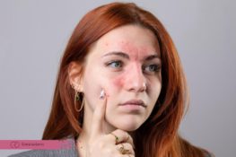 What causes filiform warts - RemoteDerm