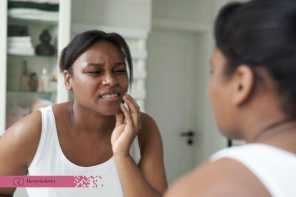 Facial Plethora: Causes and Treatments - RemoteDerm