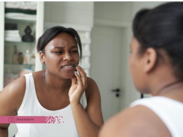 Rosacea on Black Skin: In-Depth Guide - RemoteDerm