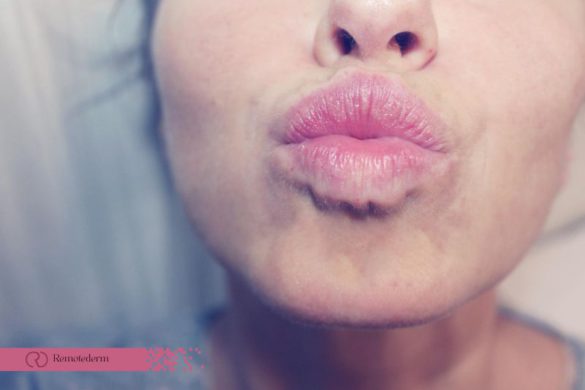 How To Get Rid of Sebum? - RemoteDerm