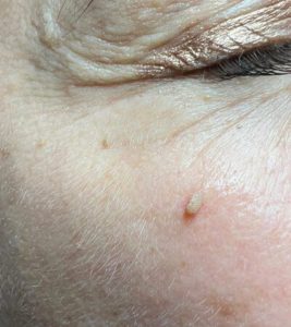 What causes filiform warts - RemoteDerm