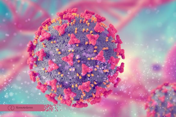 Sebaceous Hyperplasia cause, Symptoms,Treatments - Remotederm